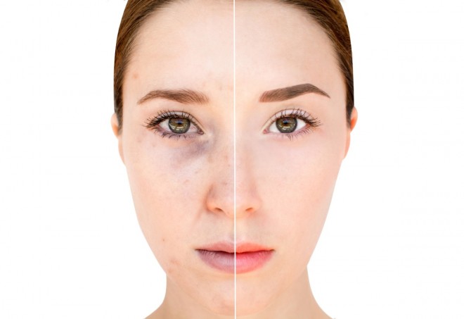 Jednostavno rešenje za otklanjanje fleka sa lica :: NEGUJ SE